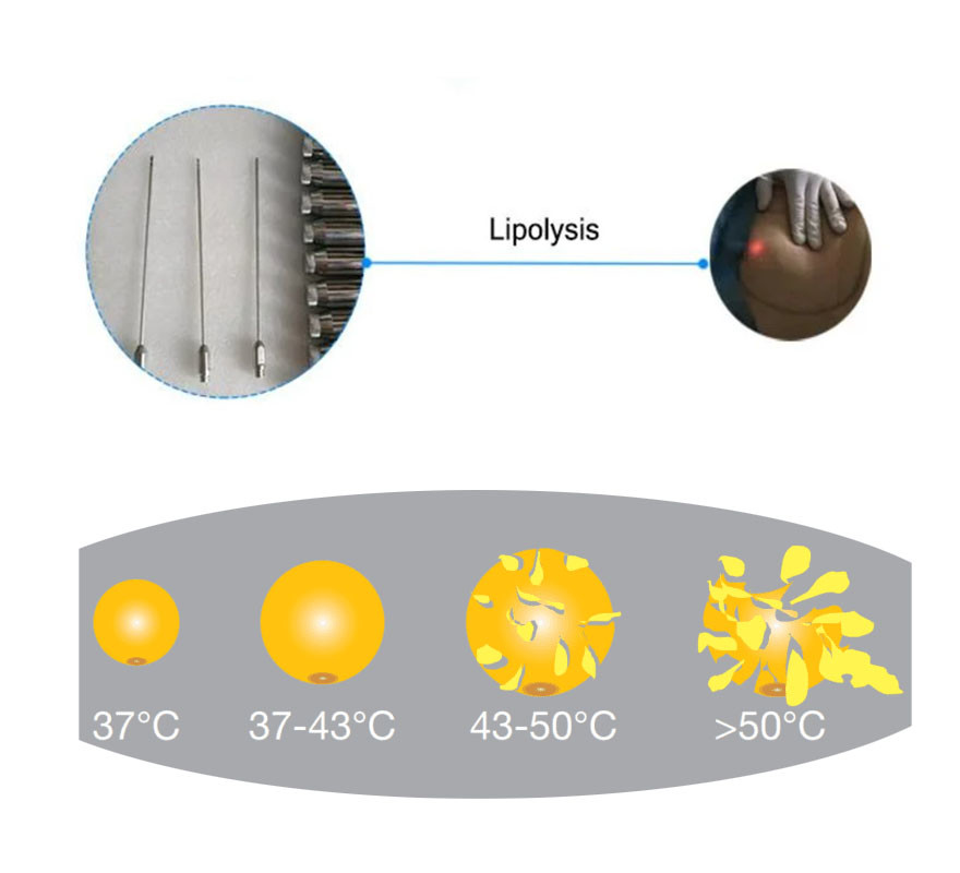 Surgery lipolysis face lift endolaser bare fiber evlt radial fiber ...